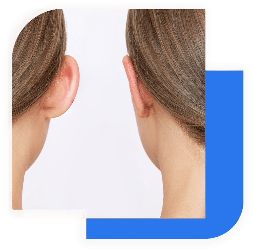 Otoplasty Ear Surgery Turkey - starts from £1,999 - All Inclusive ...